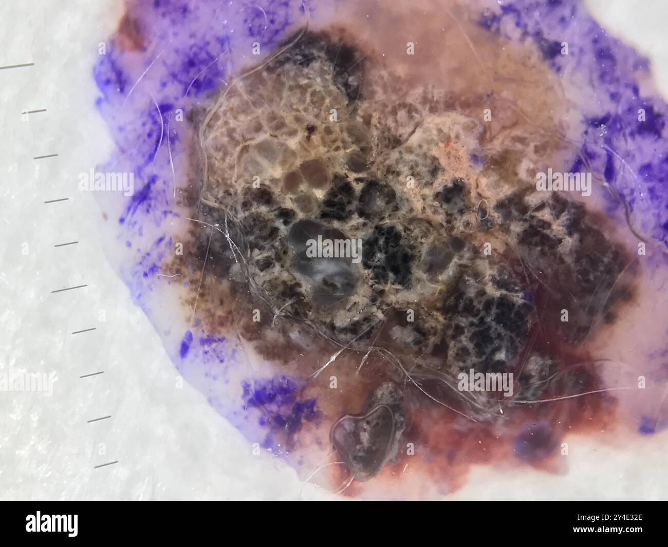 Dermatoscope Image Of A Melanoma On The Cheek Of A 28 Year Old White Dermatoscope Image Of A Melanoma On The Cheek Of A 28 Year Old White