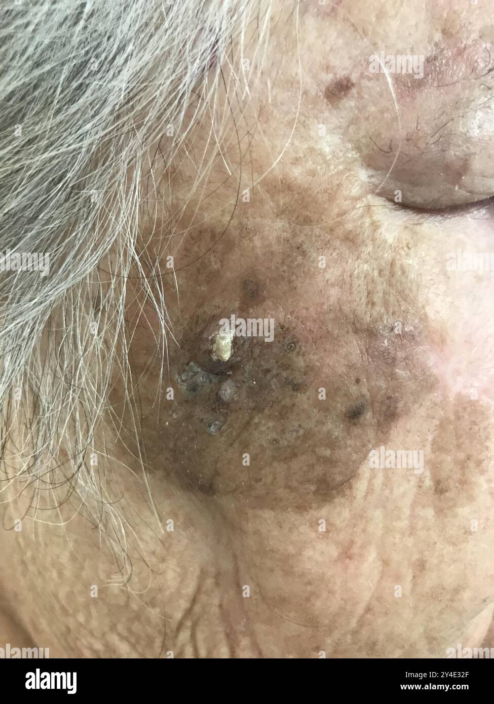 Squamous cell carcinoma on the face of a Hispanic female patient. This ...