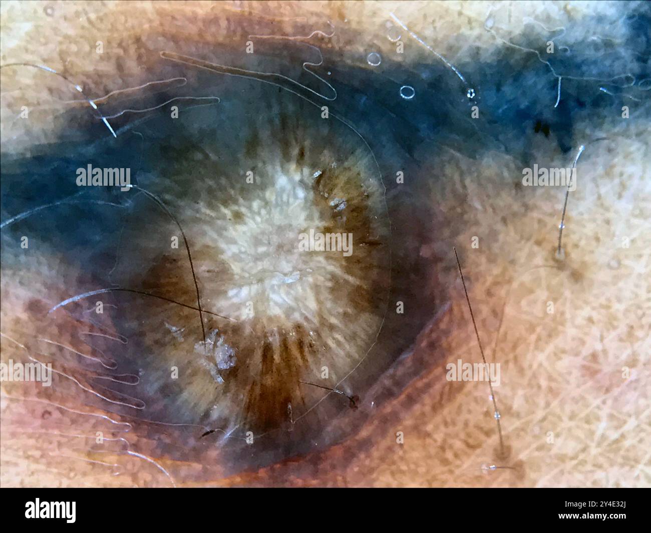 Dermatoscope image of a dermatofibroma on a male African-American ...