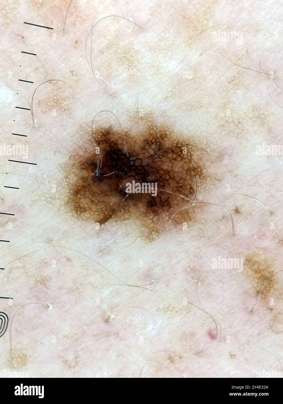 Dermatoscope image of a mole. This skin mark is caused by a ...