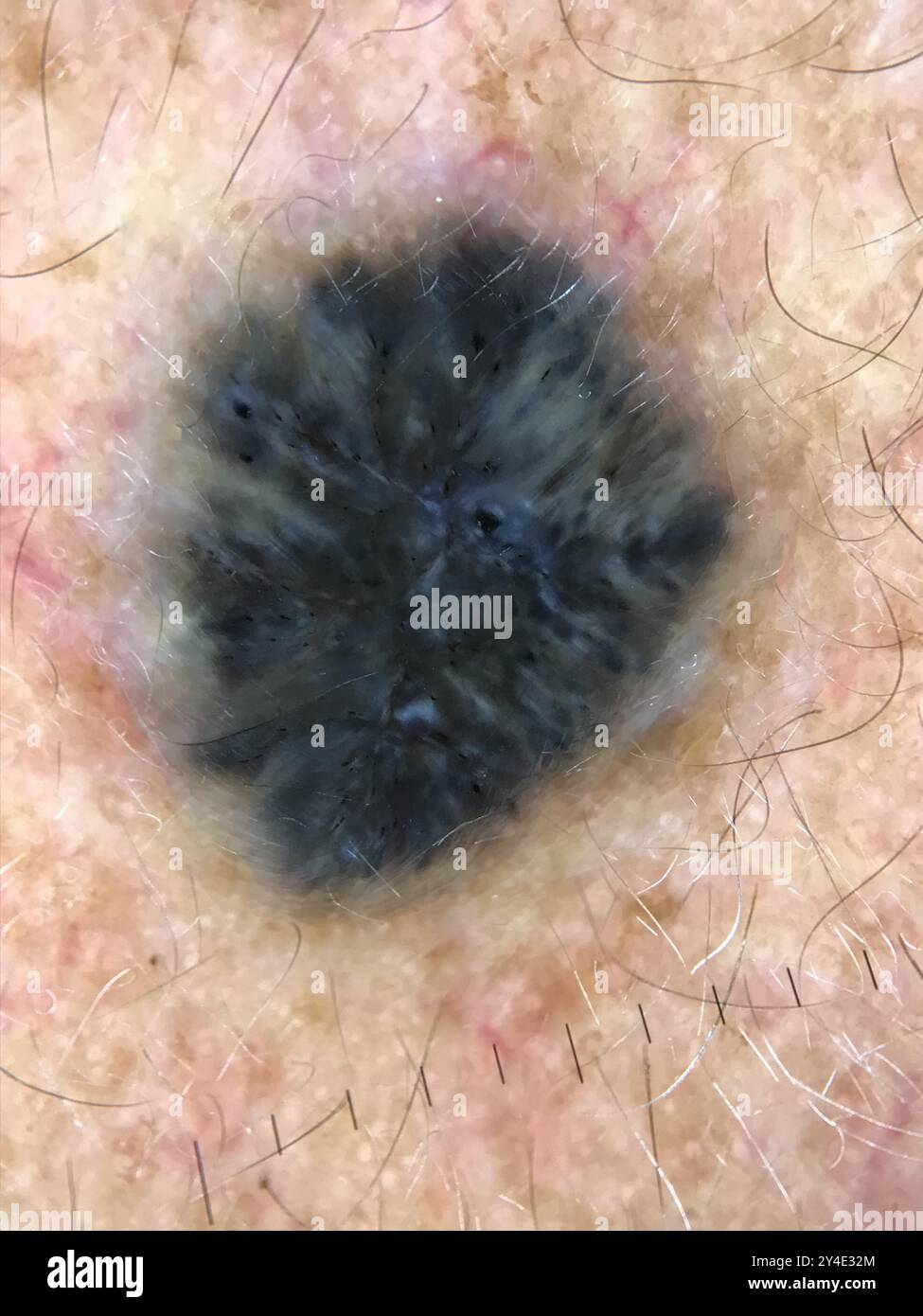 Dermatoscope image of of a pigmented basal cell carcinoma (BCC), or ...