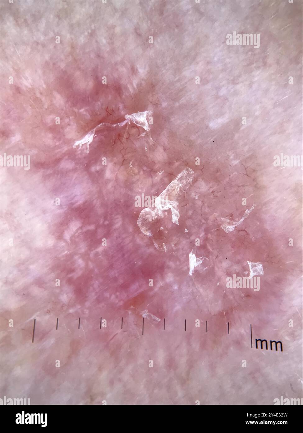 Dermatoscope image of a micronodular basal cell carcinoma (BCC), or ...
