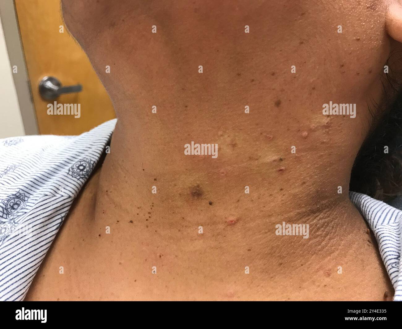 Neck of a 50 year old Hispanic female patient who has had skin tags ...