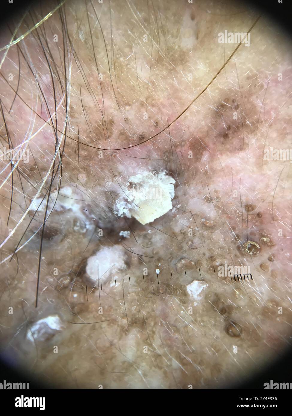Dermatoscope image of a squamous cell carcinoma on the face of a ...