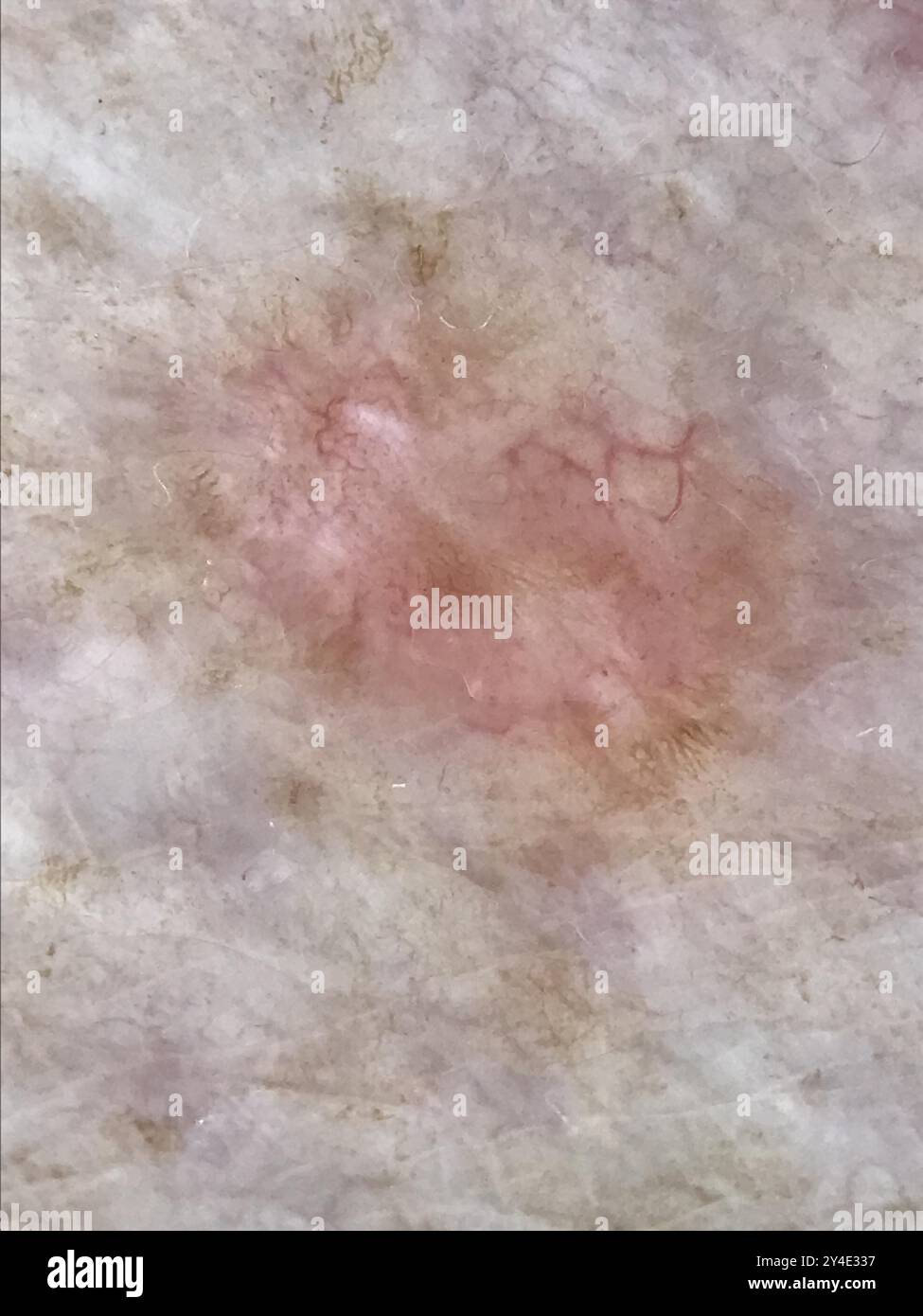 Dermatoscope image of a dermatofibroma on a 66 year old patient's skin ...