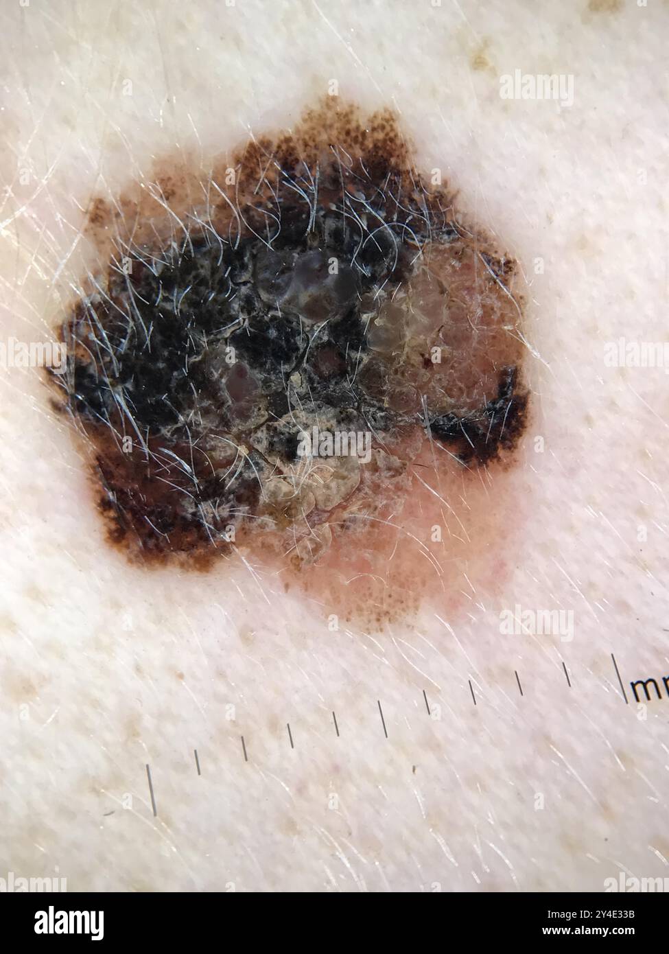 Dermatoscope image of a melanoma on the cheek of a 28 year old white ...