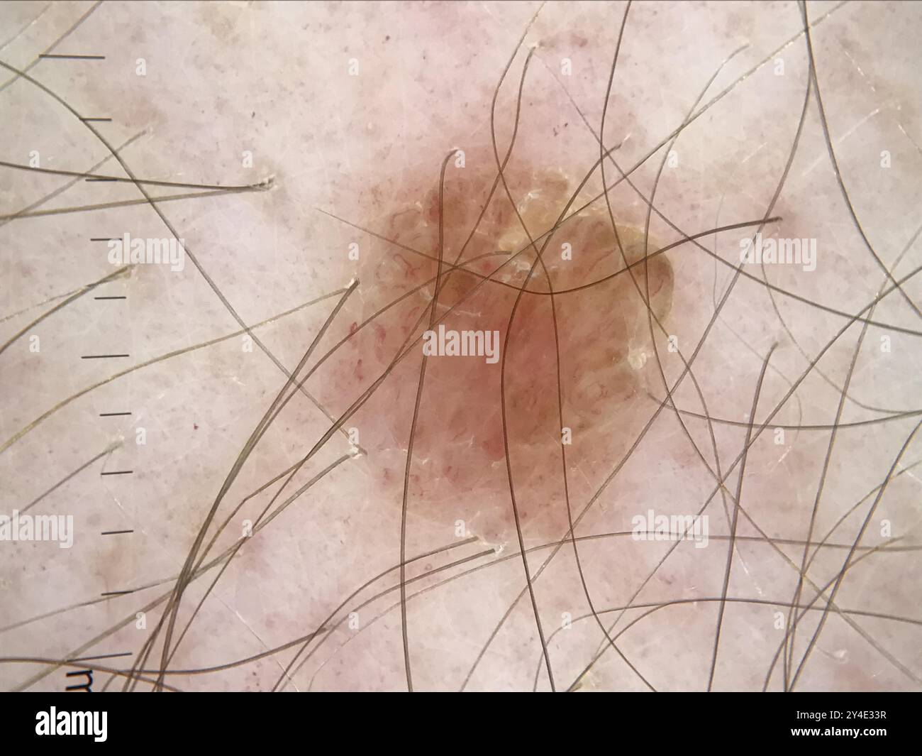 Seborrheic keratosis and intradermal naevus, dermoscopy Stock Photo - Alamy