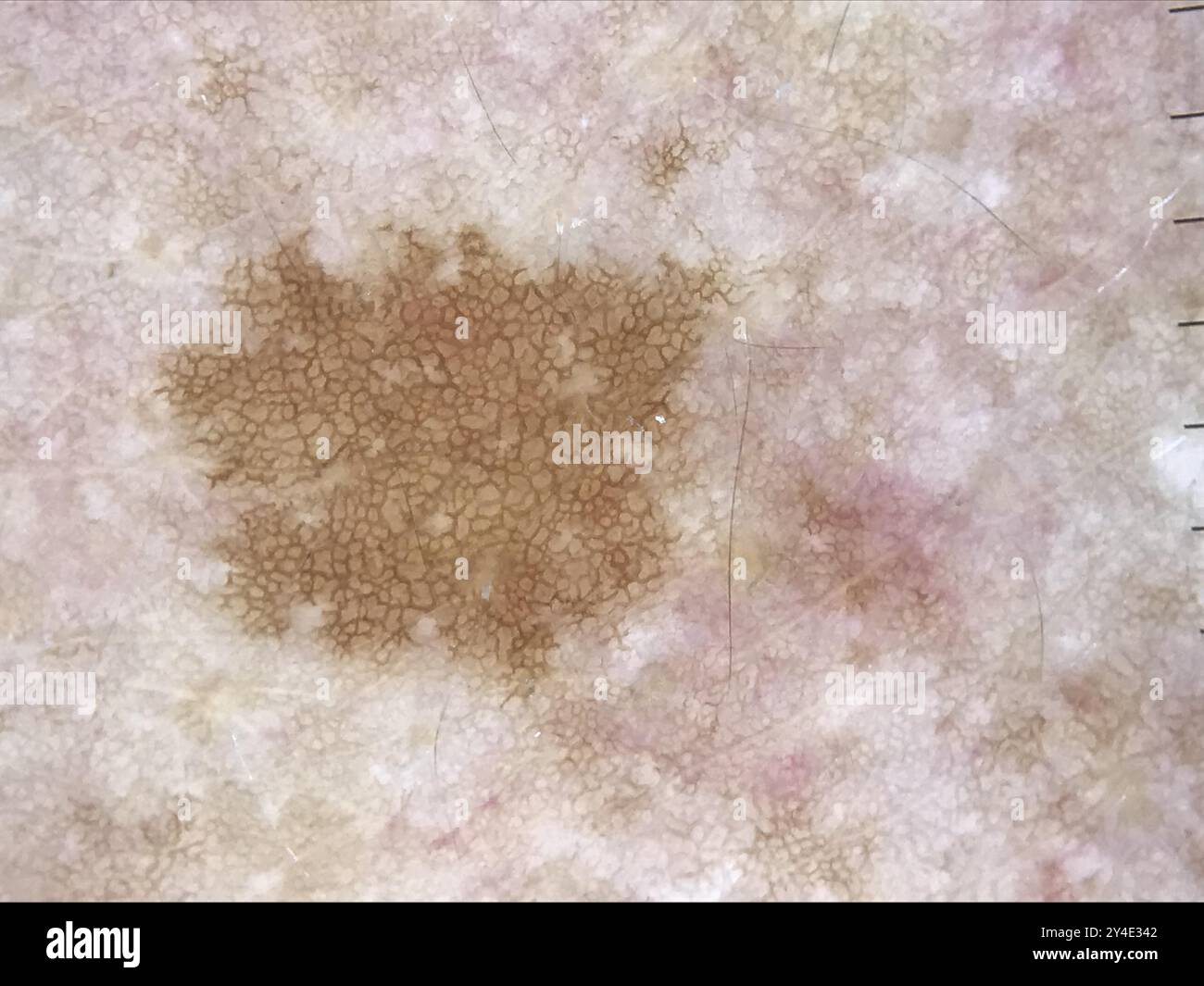 Dermatoscope image of a solar lentigo on a patient's skin. A solar ...