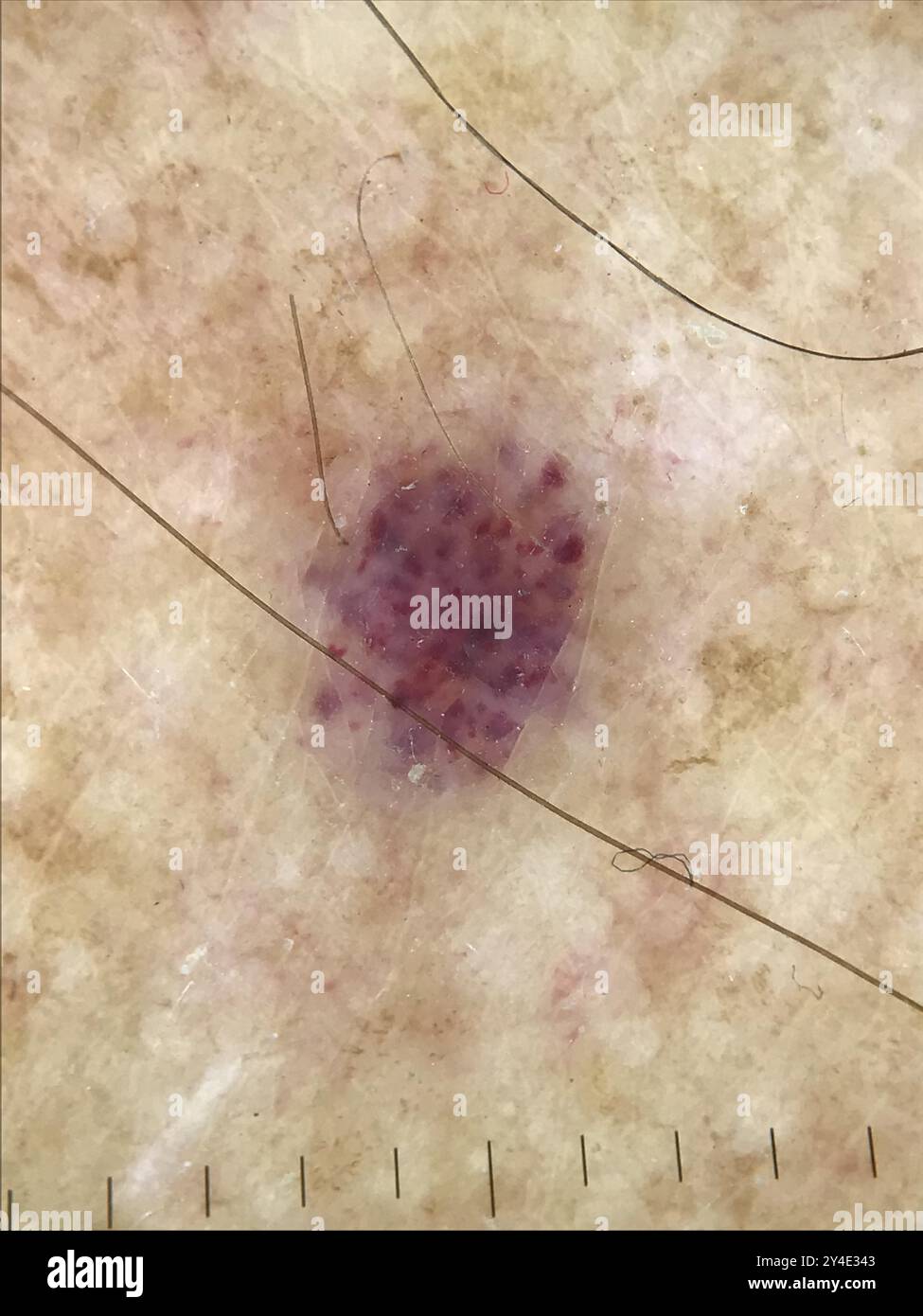 Dermatoscope image of a haemangioma on a patient's trunk. Haemangiomas ...