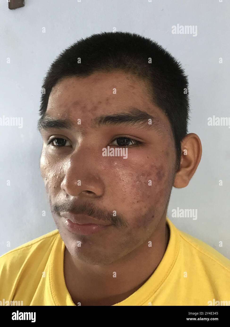 Nodulocystic acne on the face of a 16 year old boy that is improving ...