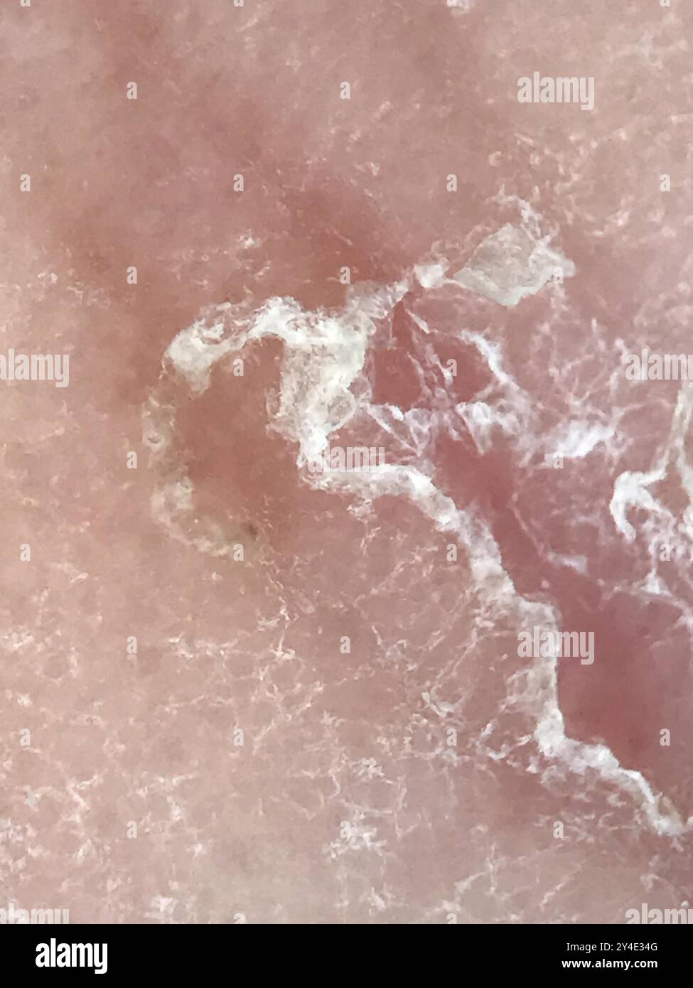 Dermatoscope image of the skin of a 19 year old patient infected with ...