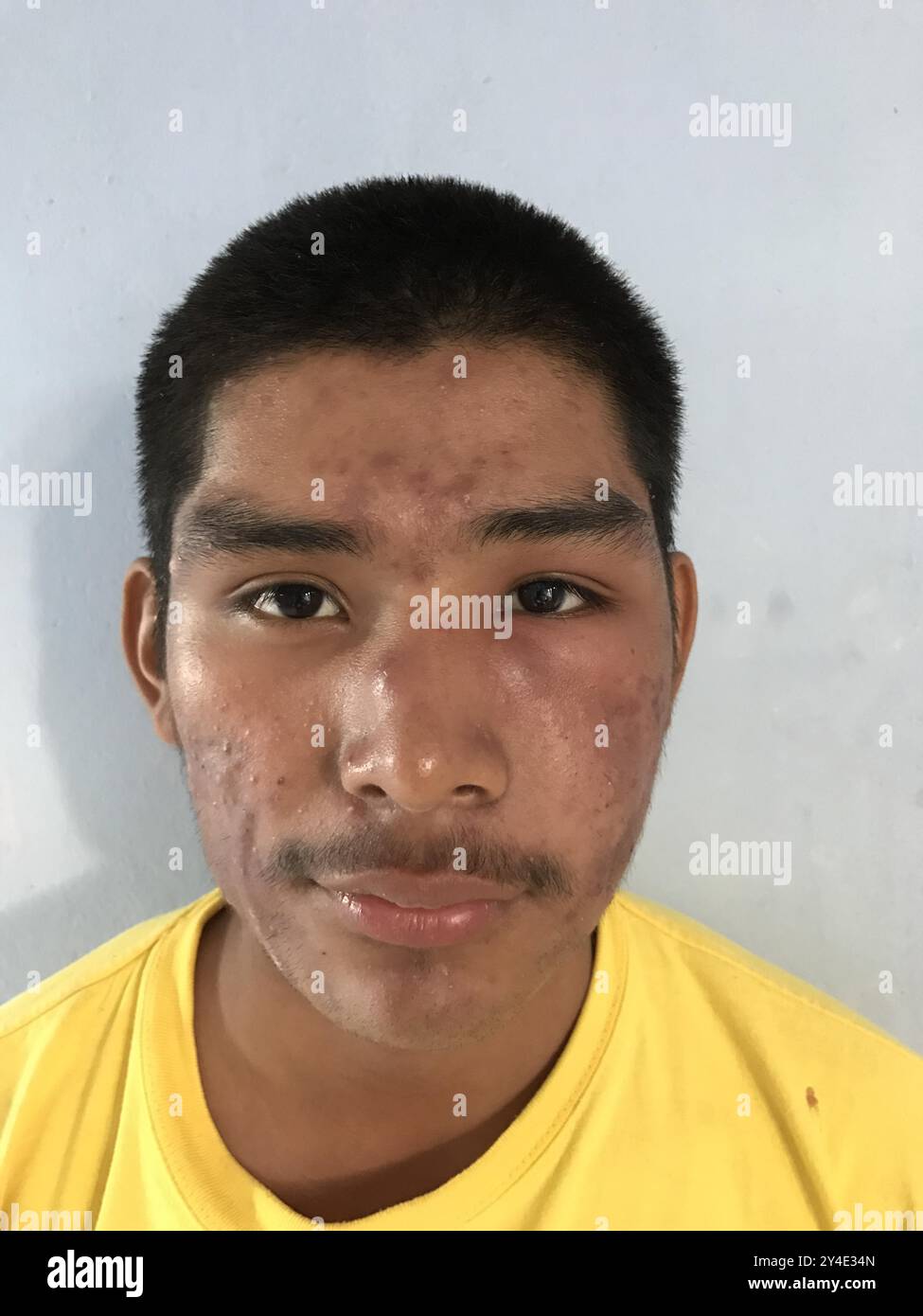Nodulocystic acne on the face of a 16 year old boy that is improving ...