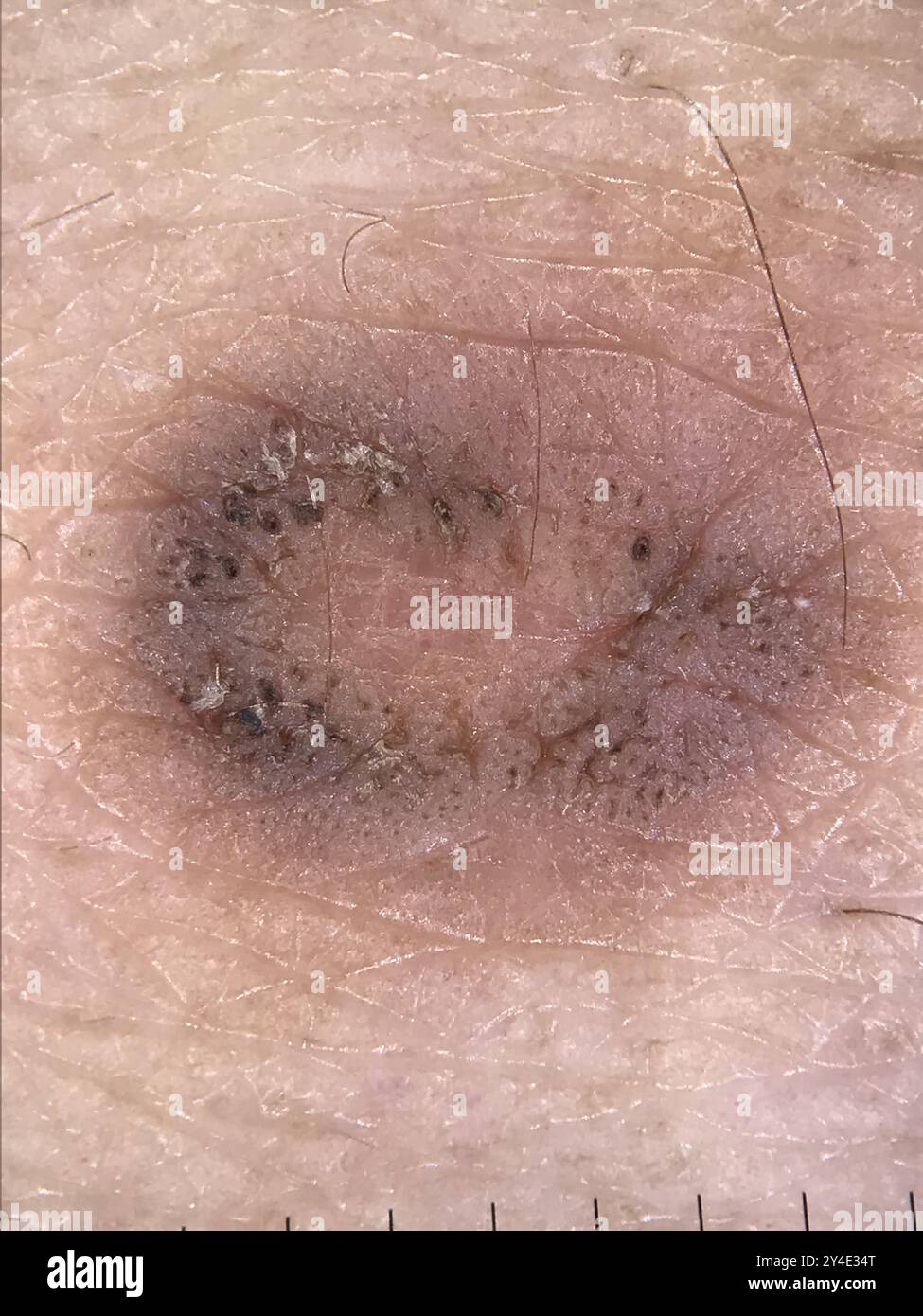 Dermatoscope image of a dermatofibroma on a patient's abdomen ...