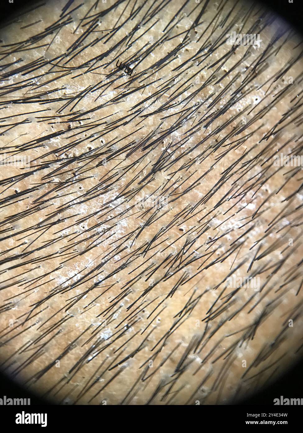 Dermatoscope image of a ringworm infection a patient's scalp. Ringworm ...