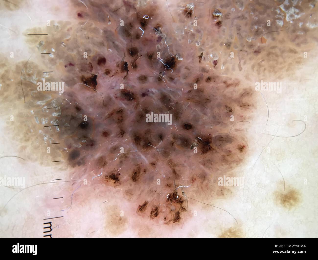 Dermatoscope image of a seborrheic keratosis. This skin growth, also ...
