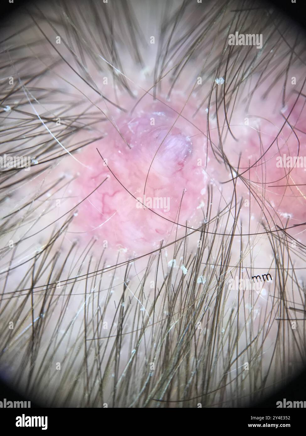 Dermatoscope image of an eccrine spiradenoma on a patient's scalp. This ...