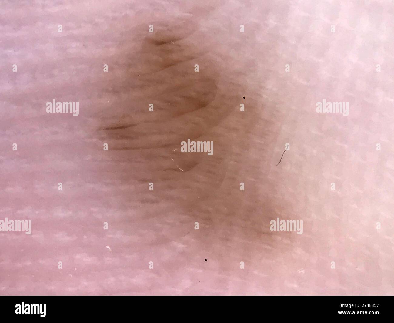 Dermatoscope image of a mole on the sole of the foot. This skin mark is ...