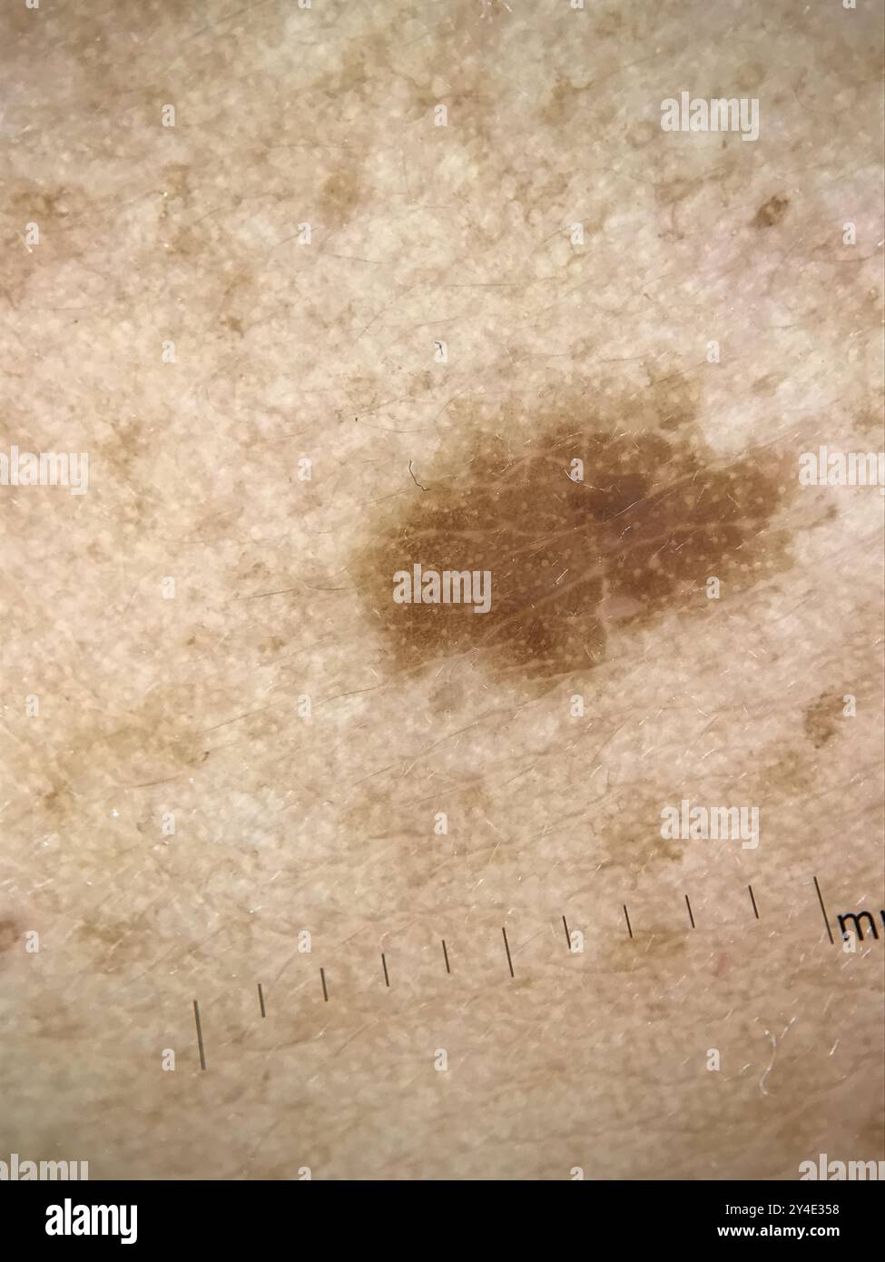 Dermatoscope image of a solar lentigo on a 54 year old Hispanic female ...