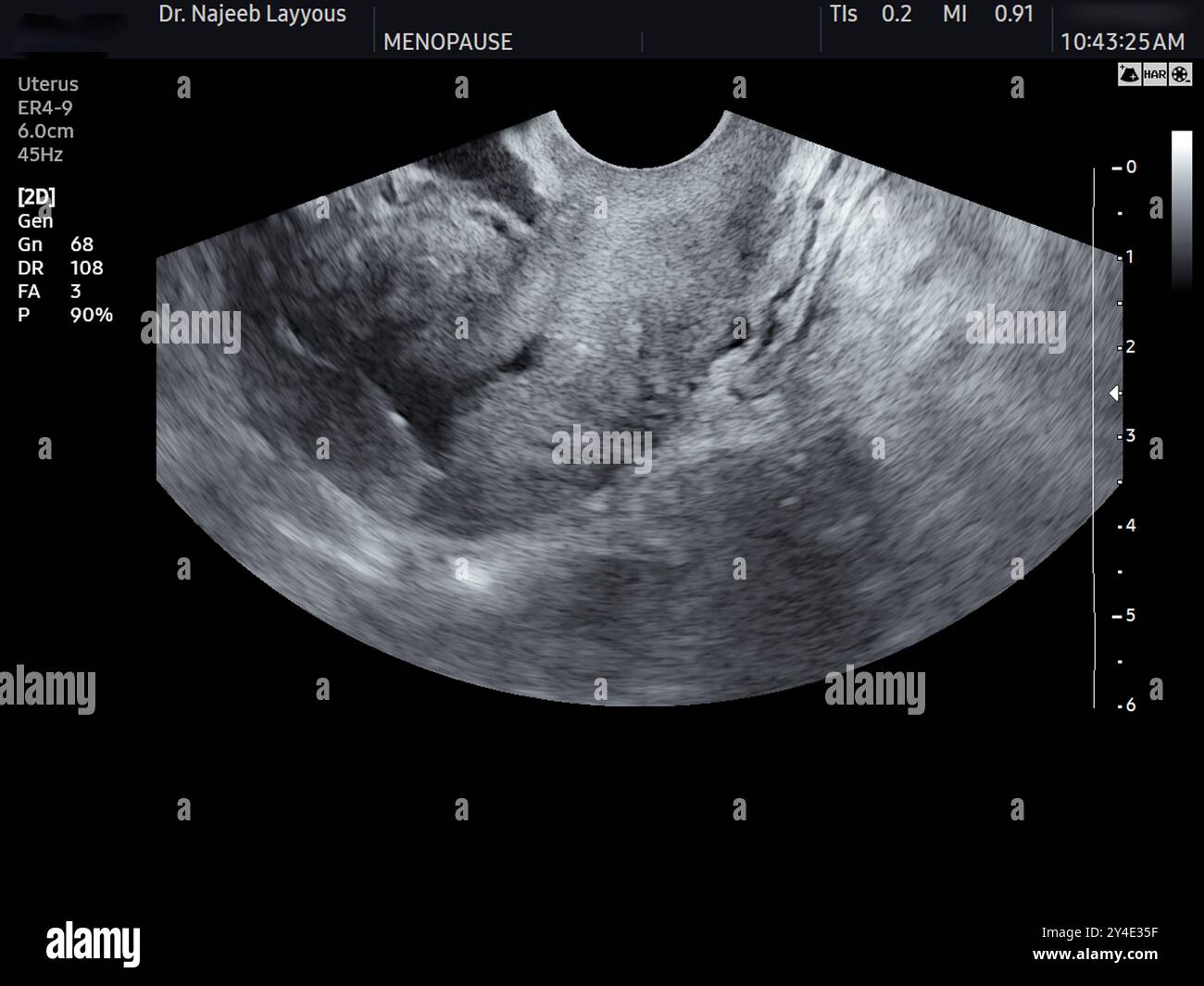 Ultrasound scan of the uterus (womb) of a menopausal woman. The ...