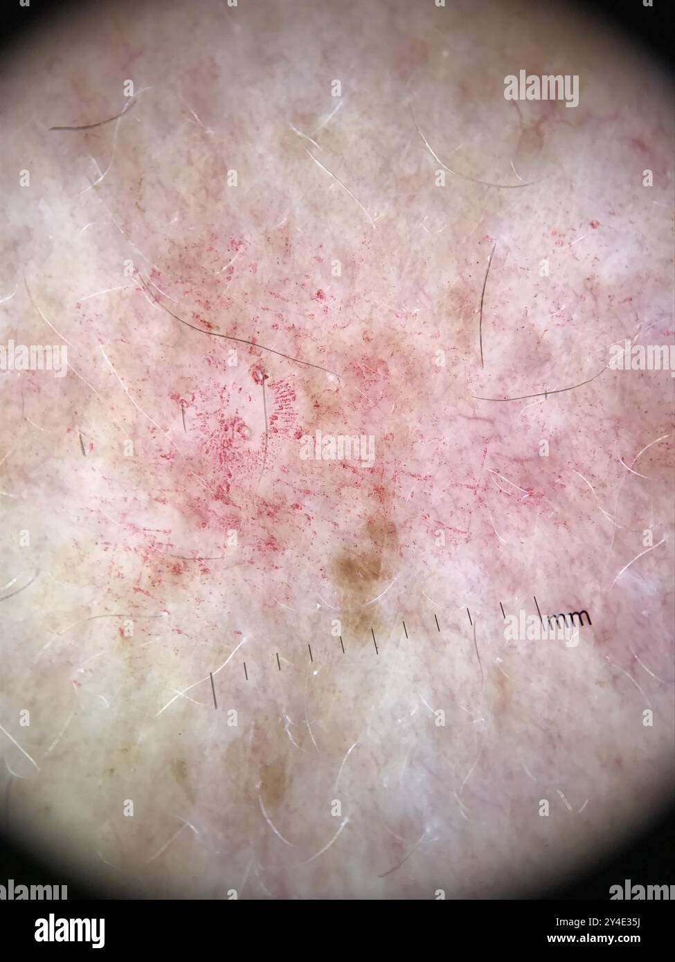 Large cell acanthoma on the skin of a 69 year old white female patient ...