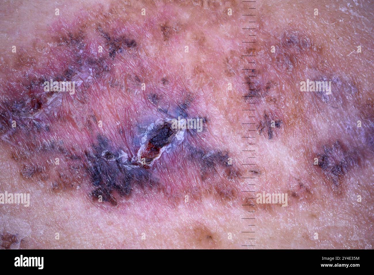 Basal cell carcinoma, dermoscopy Stock Photo - Alamy