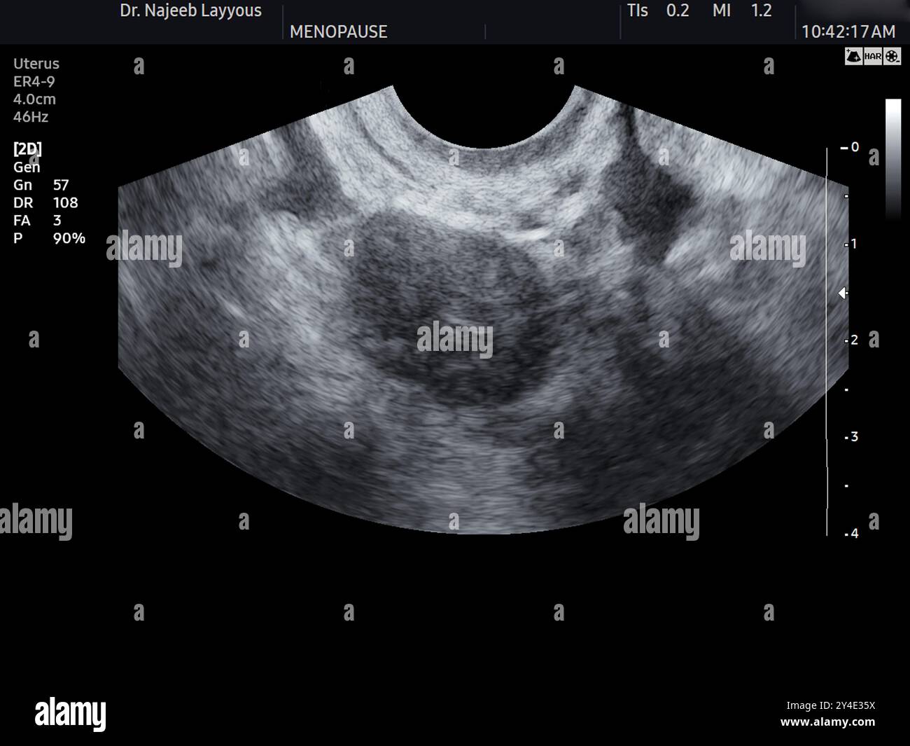 Ultrasound scan of the uterus (womb) and ovaries of a menopausal woman ...