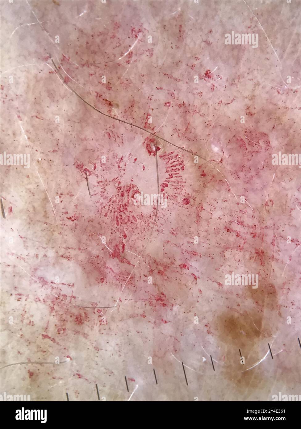 Large cell acanthoma on the skin of a 69 year old white female patient ...