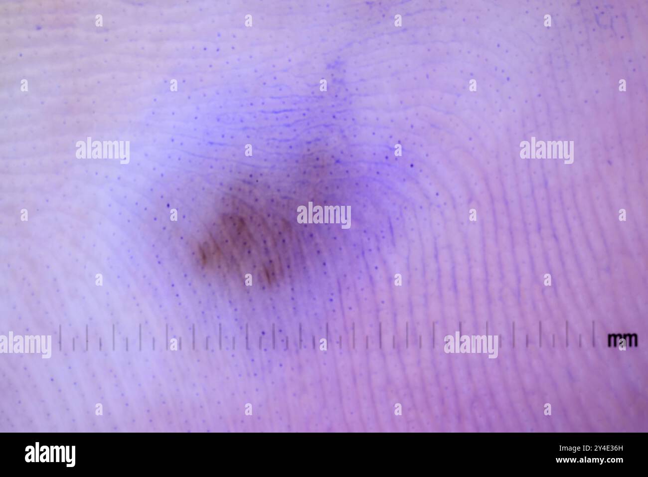 Dermatoscope image of a mole on the sole of the foot of a 53 year old ...