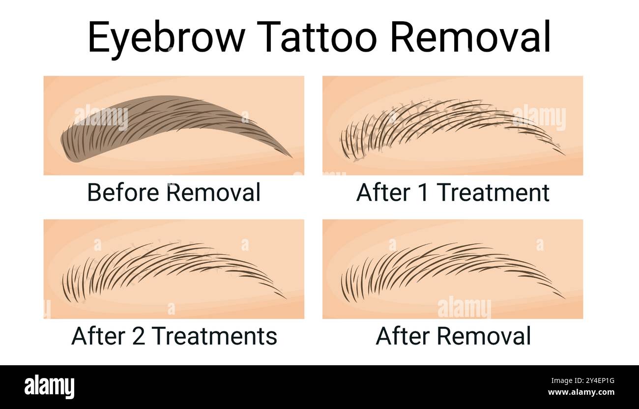 Eyebrow Tattoo Removal Before And After Results Vector Illustration