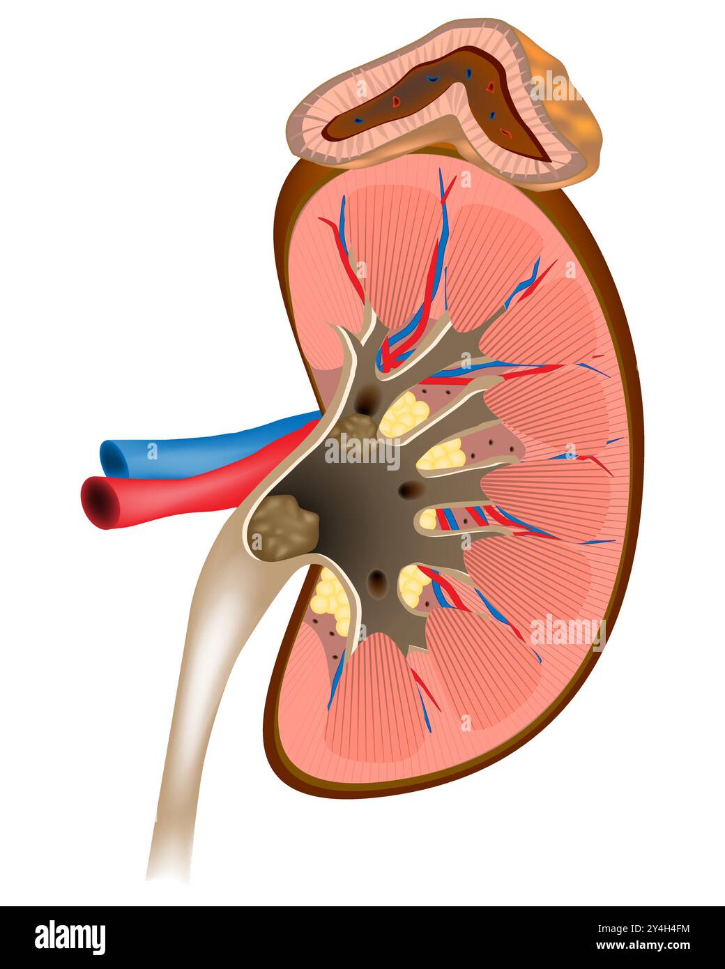 Kidney stone disease. Renal calculus disease, nephrolithiasis or ...