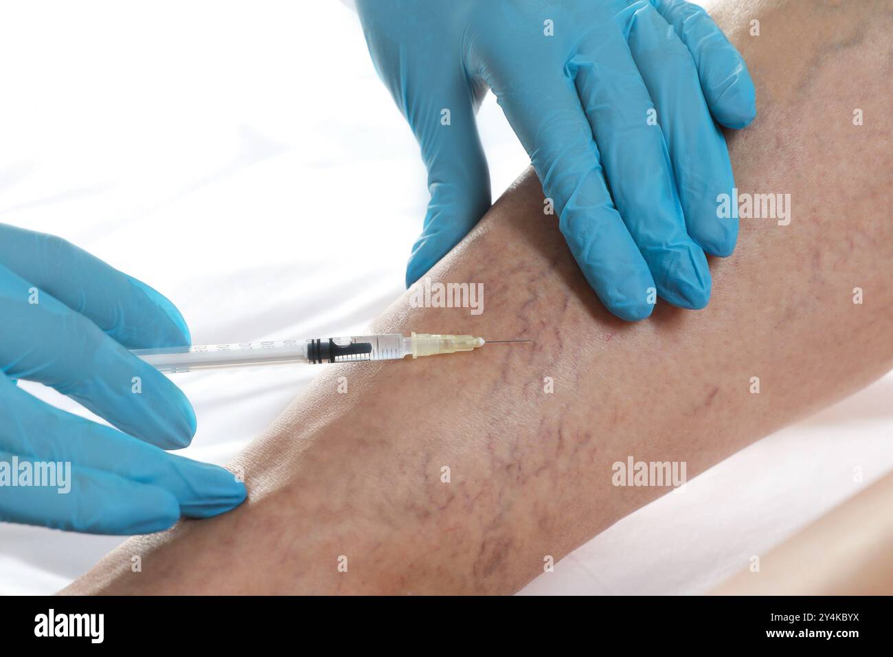 Varicose veins treatment. Doctor giving injection to patient indoors ...