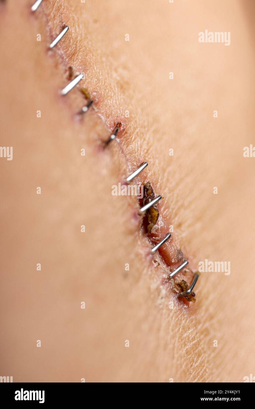 Scab scar hi-res stock photography and images - Alamy
