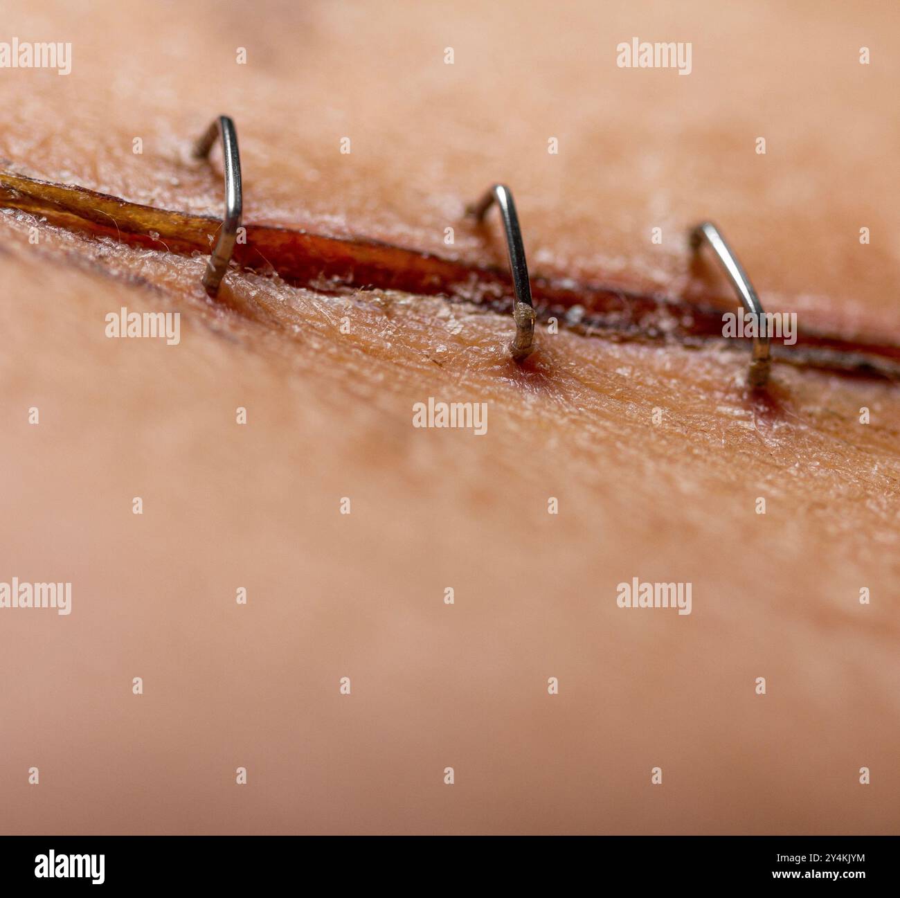 Vertical Hysterectomy Scar With Stapels