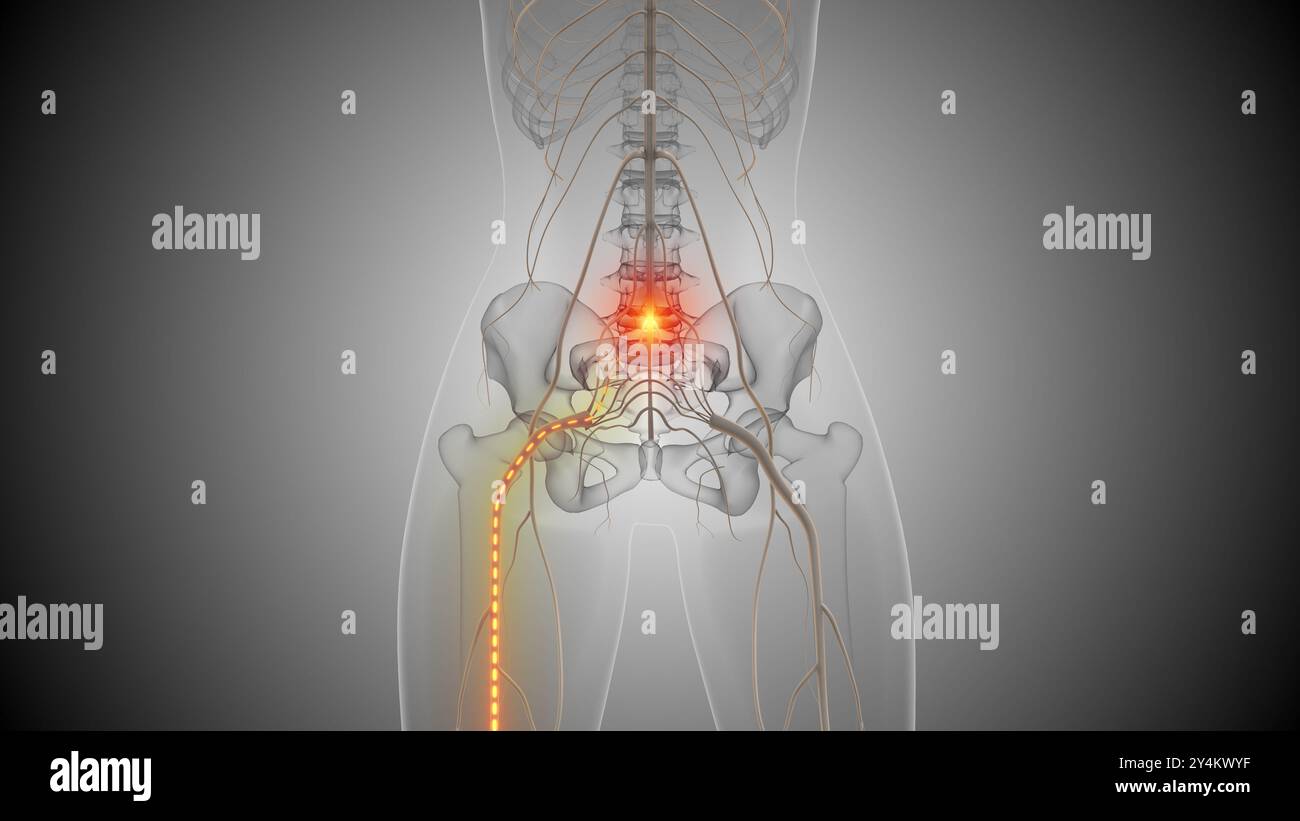 Sciatica causes lower back and leg pain Stock Photo - Alamy