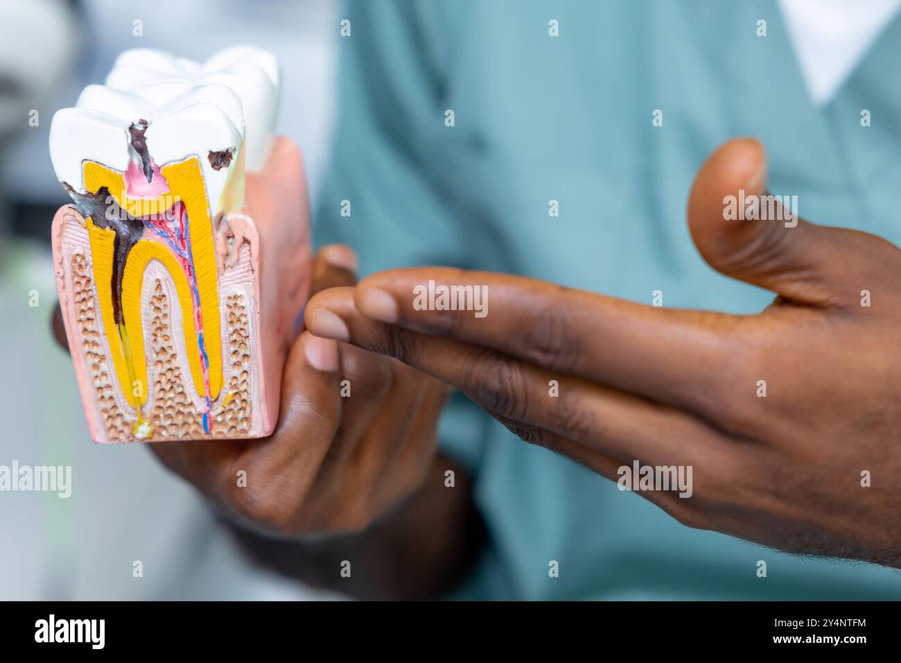Detailed diagram illustrating tooth decay and the stages of caries ...