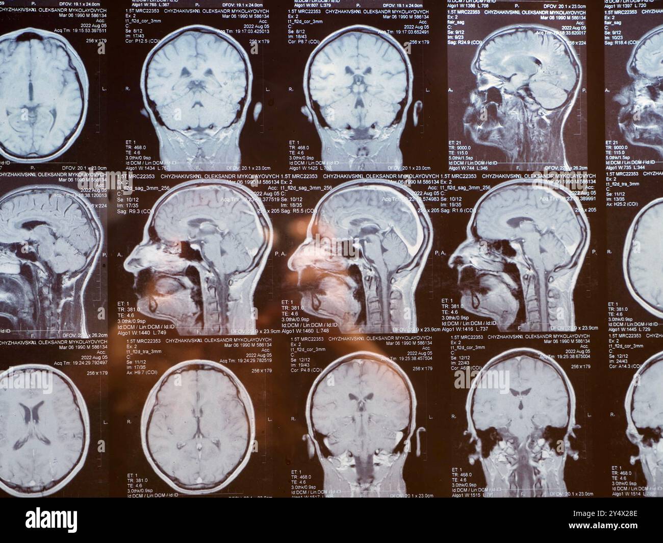 MRI of the human brain of a patient with multiple sclerosis of the ...