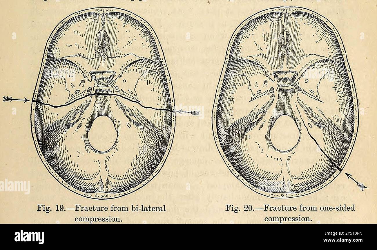 Lateral compression hi-res stock photography and images - Alamy