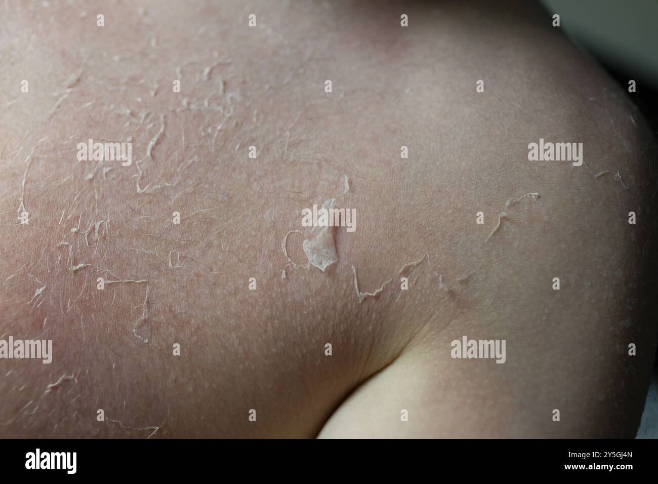 Man sun burn skin damage peeling after exposure sun Stock Photo - Alamy