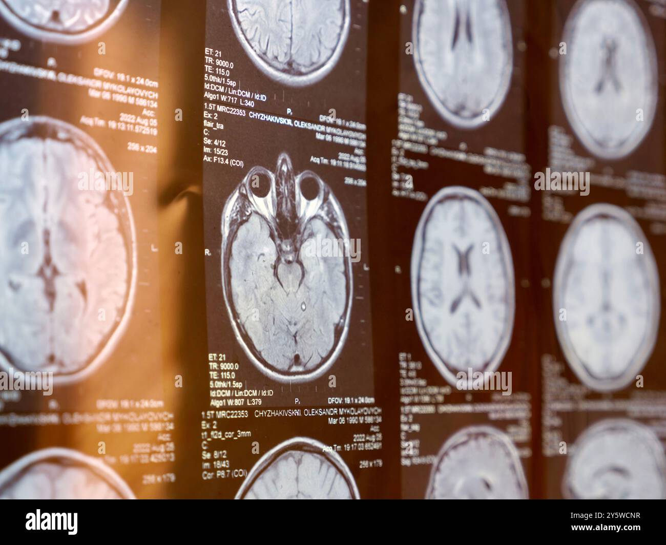 MRI of the human brain of a patient with multiple sclerosis of the ...