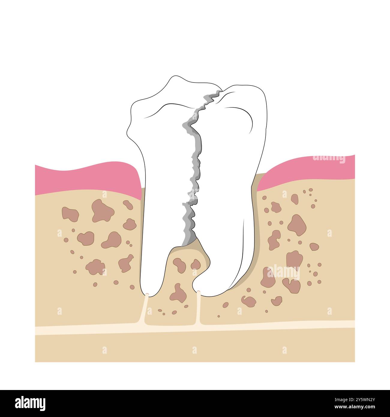 Cracked tooth medical scientific illustration. Oral trauma consequences ...