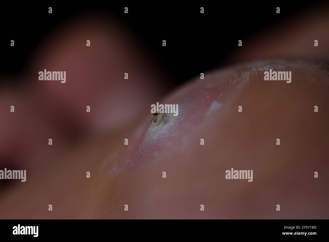 Close up wart verruca hi-res stock photography and images - Alamy