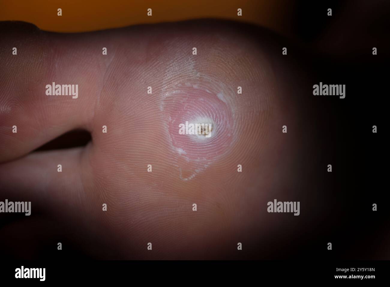 HPV wart on foot close up plantar wart. Contagious foot infection Stock ...