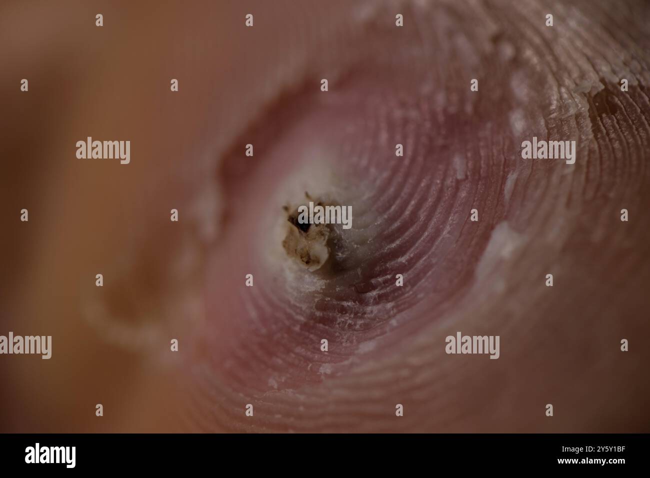 Plantar wart close up hpv infection skin disease Stock Photo - Alamy