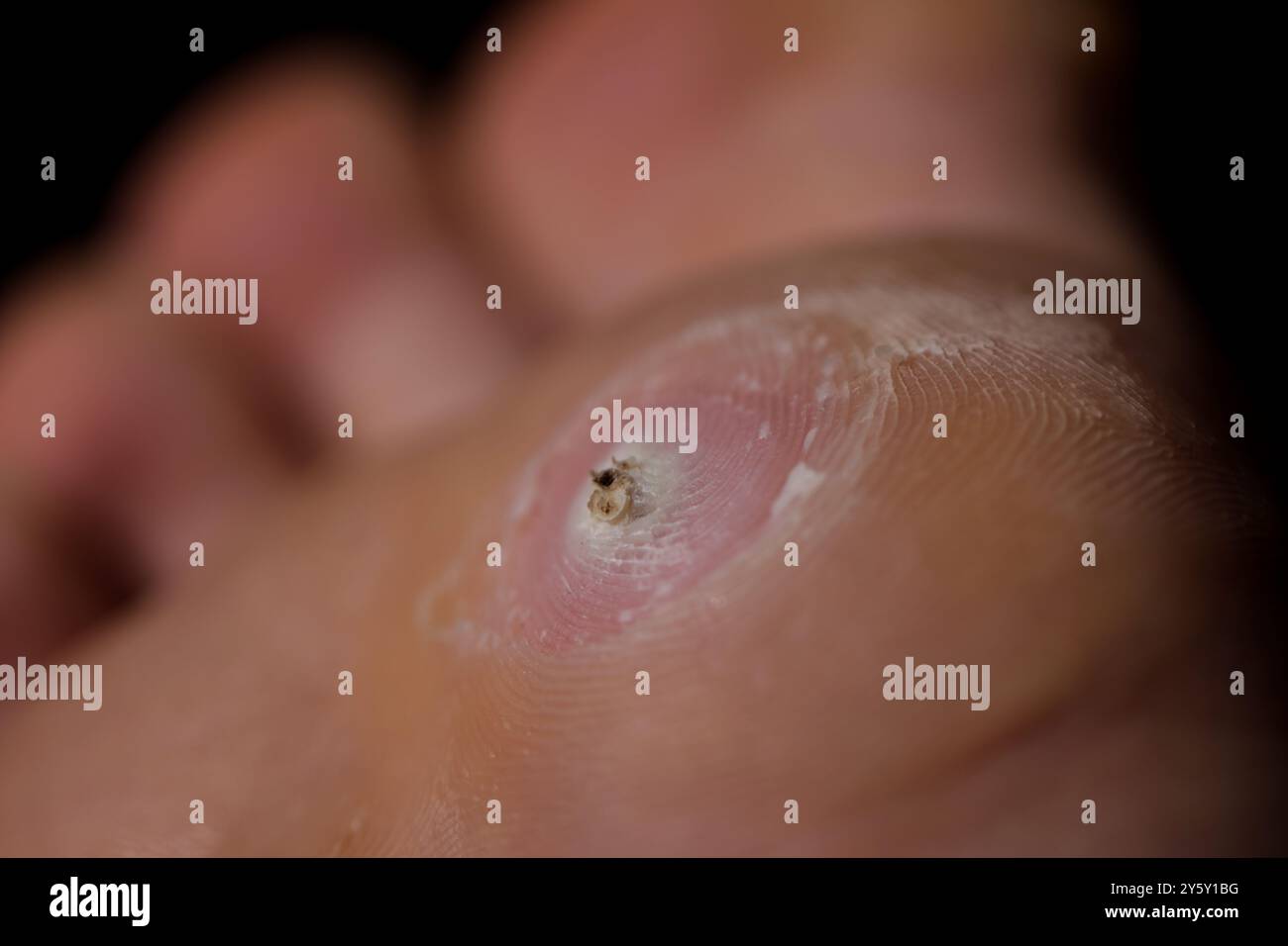 Human papillomavirus infection macro close up on sole of foot Stock ...