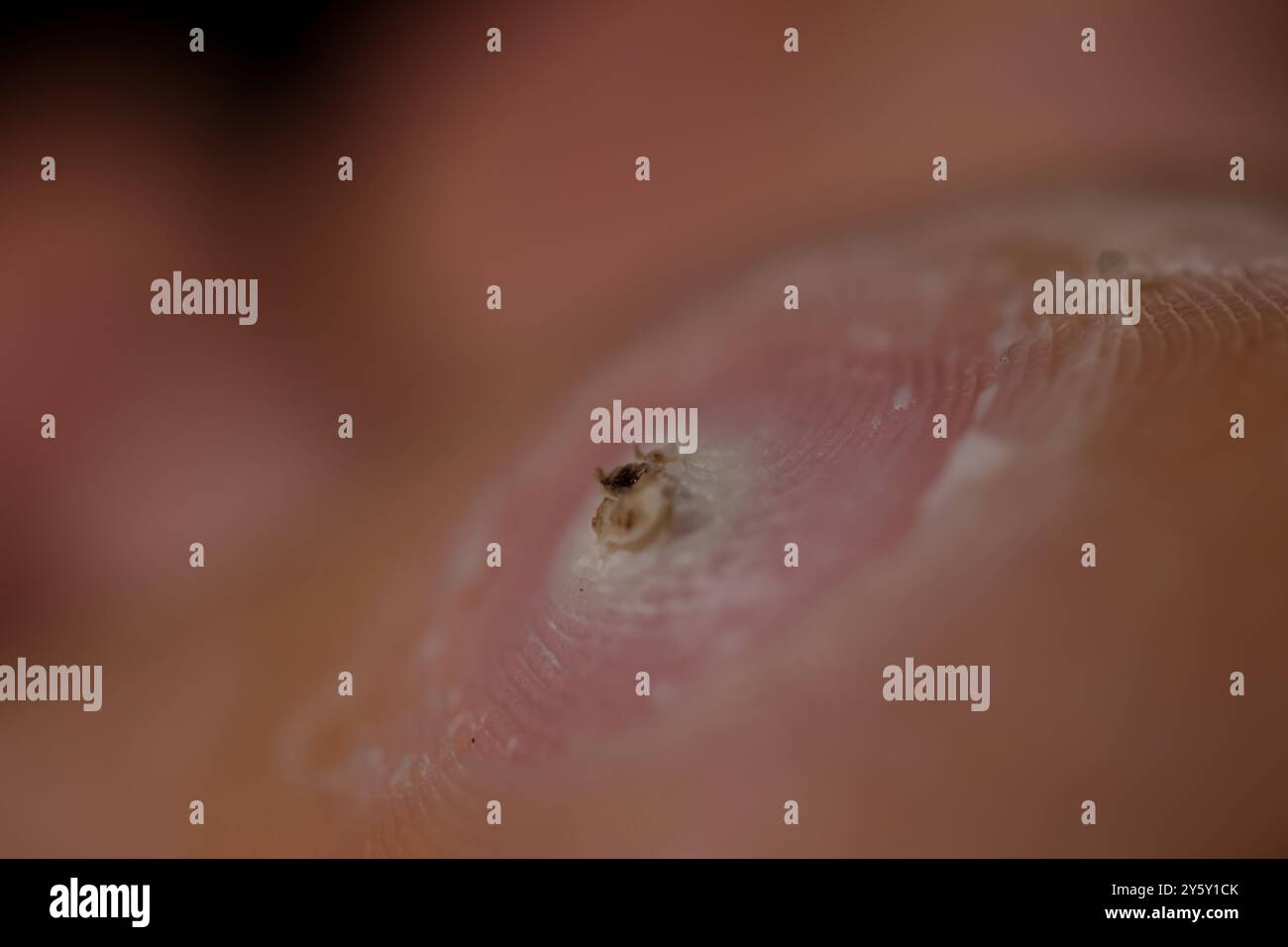 Skin wart bottom of the foot plantar wart Stock Photo - Alamy