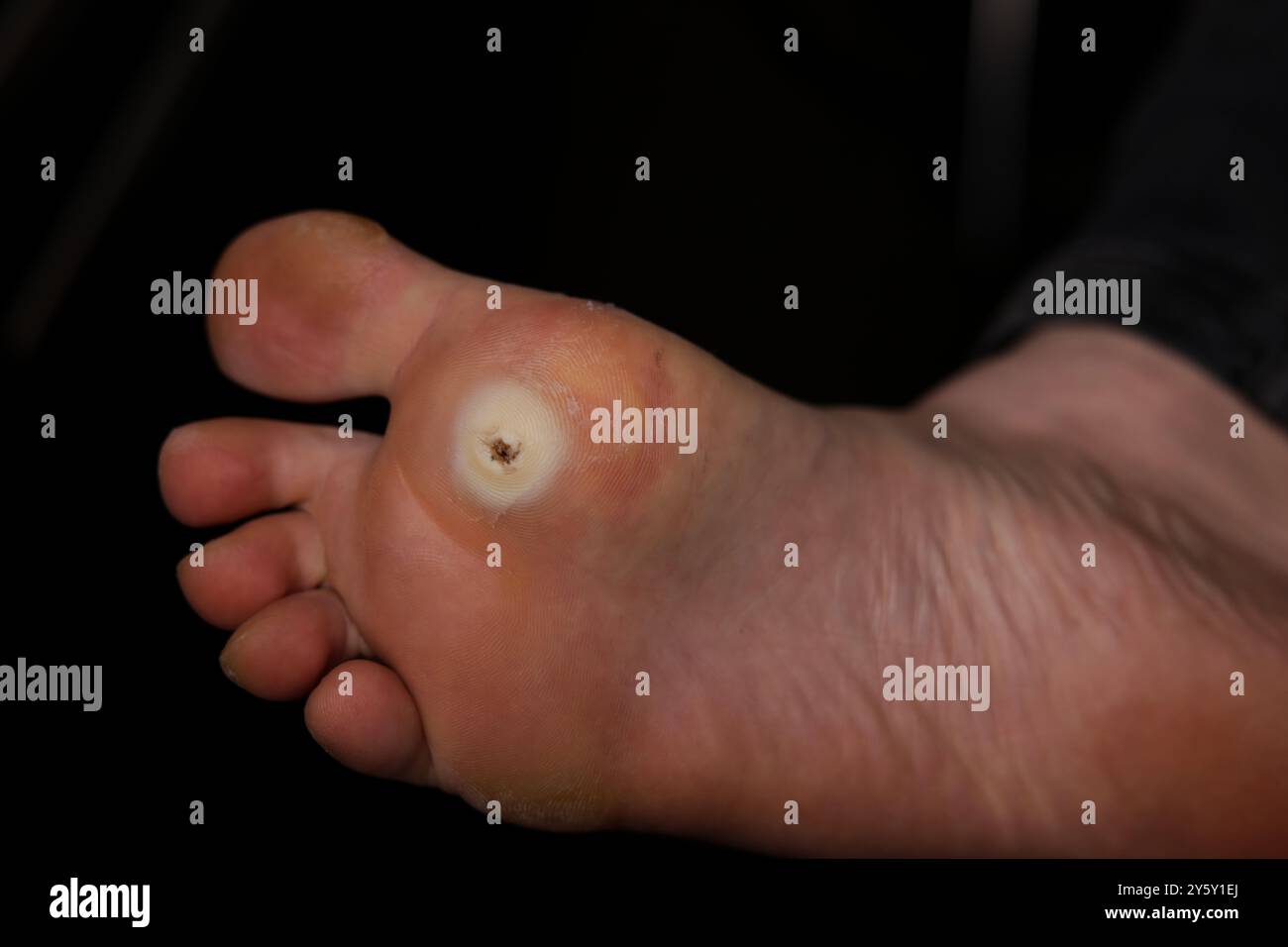 Plantar wart bottom of the foot hpv viral infection Stock Photo - Alamy