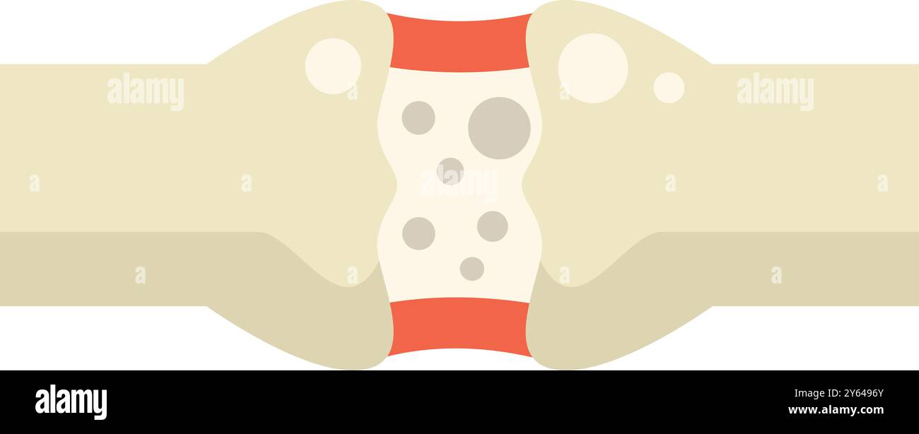 Illustration of a human joint showing osteoporosis affecting bones with ...