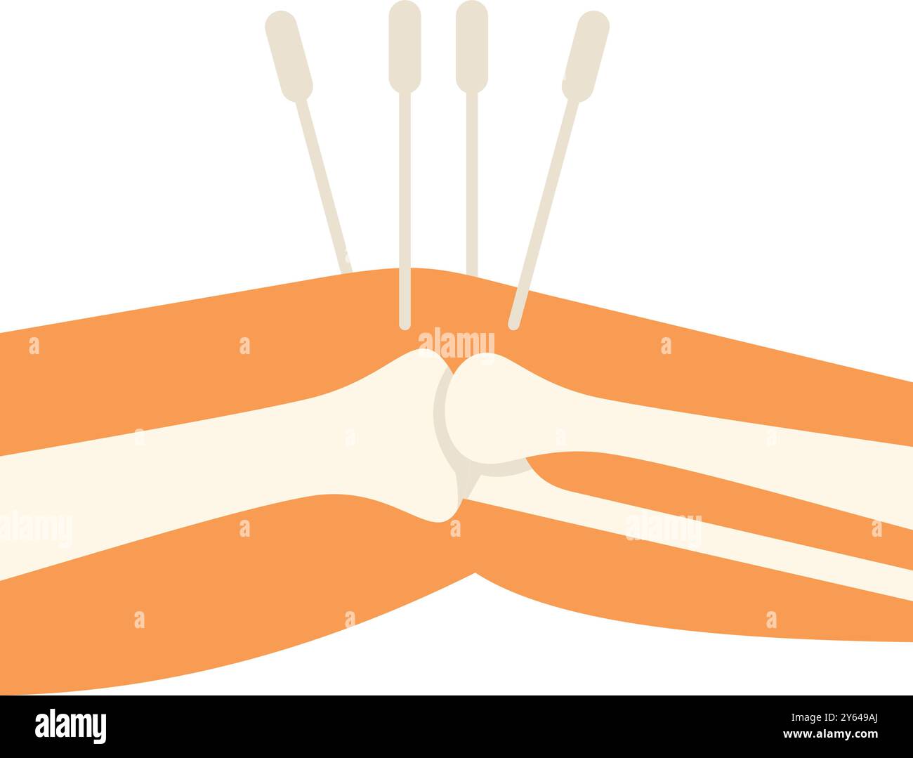 Illustration showing acupuncture needles treating pain in a human knee ...