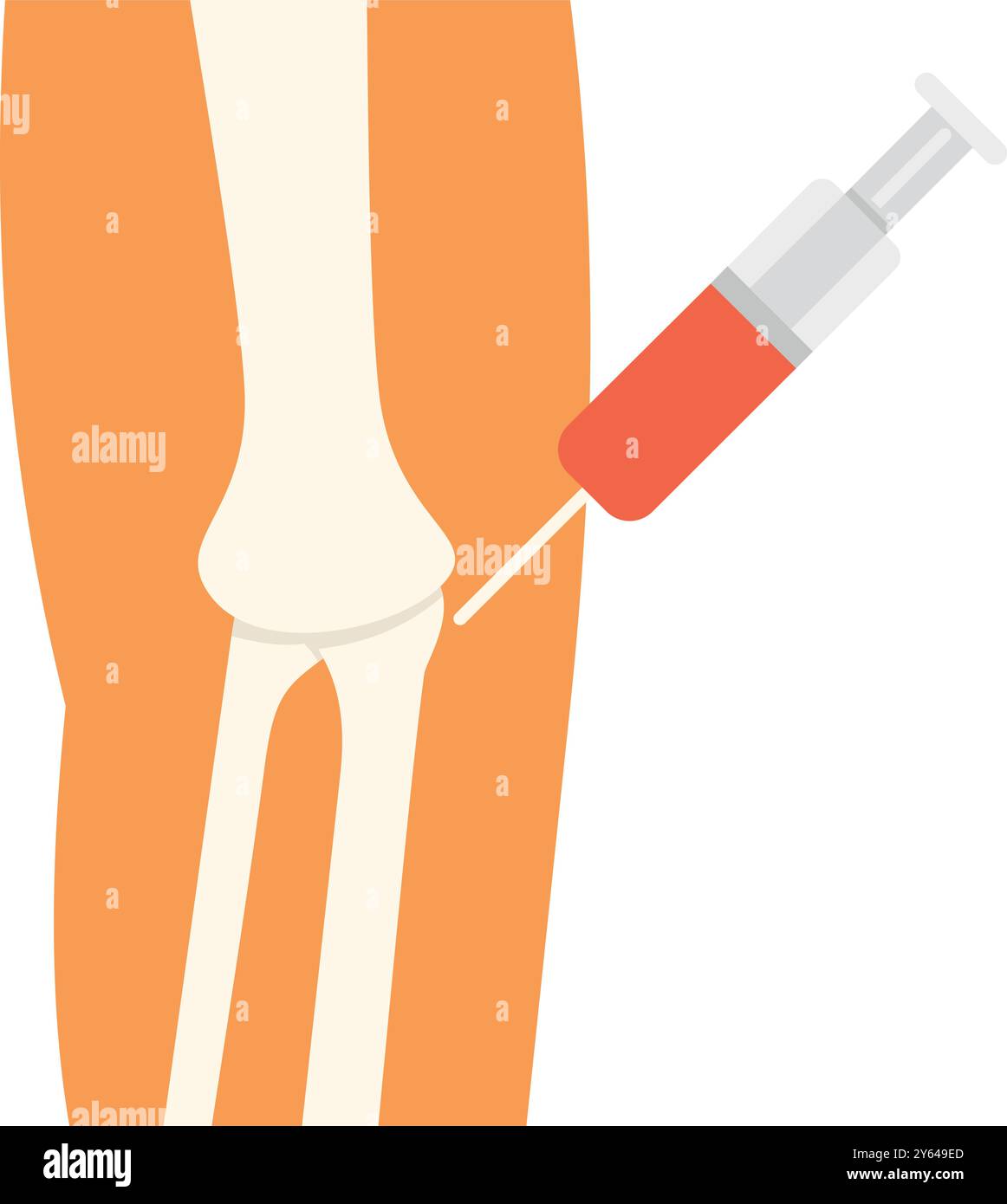 Medical illustration showing a doctor injecting cortisone into a ...