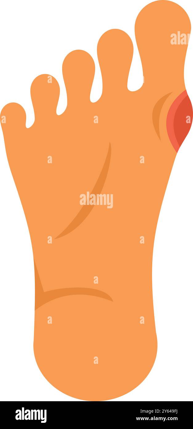 Illustration depicting the foot condition hallux valgus, commonly known ...